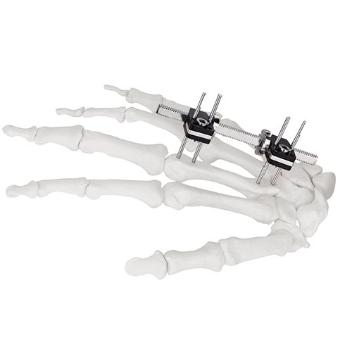Mini Fragment External Fixator (Finger and Palm) - Orthopedic Drills UK